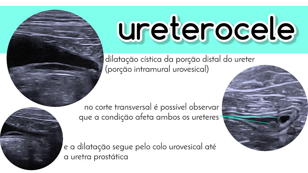 ureterocele - vem ver um caso!