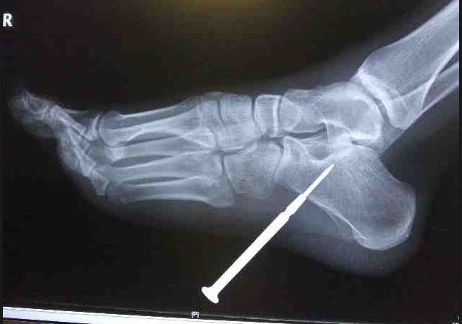 Wound Care Part 3: Puncture Wounds