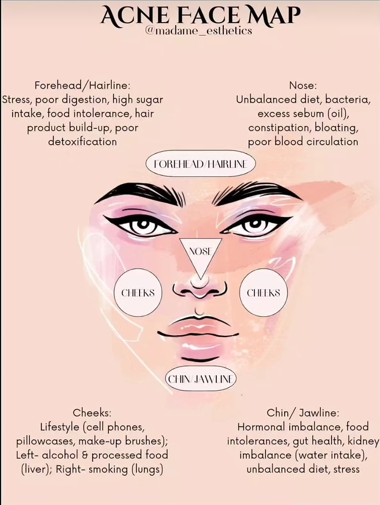 Acne Face Map