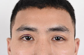 Typical Asian Monolids to Defined Double Eyelids give good look and ...