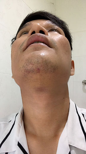 A strong chin is a classic masculine feature! Chin Augmentation by DRK ...