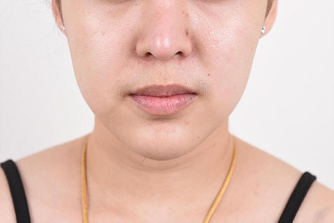 Chubby Cheeks Problem is gone in just one procedure with DRK!