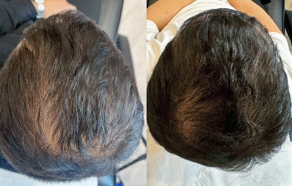 Unlocking the Secrets of PRP for Luscious Locks And Beards Unlocking the Secrets of PRP for Luscious Locks And Beards