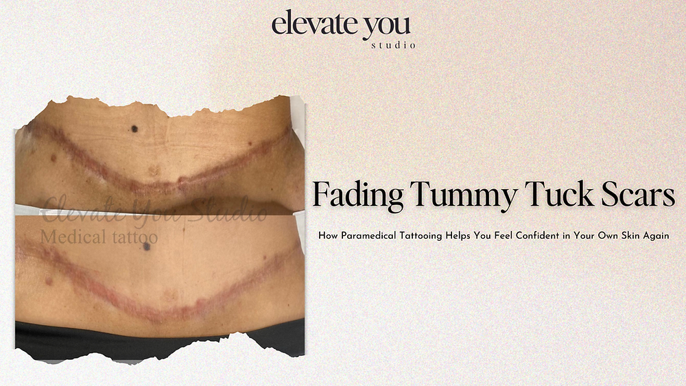 Fading Tummy Tuck Scars Elevate You Studio