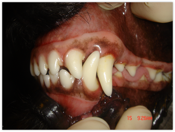 Case: Orthodontic Treatment of a Mandibular Canine Tooth Causing Trauma