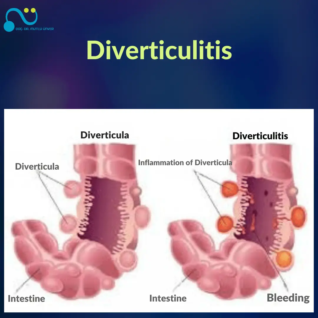 Bleeding From Anus - Rectal Bleeding - Causes and Treatments - Assoc ...