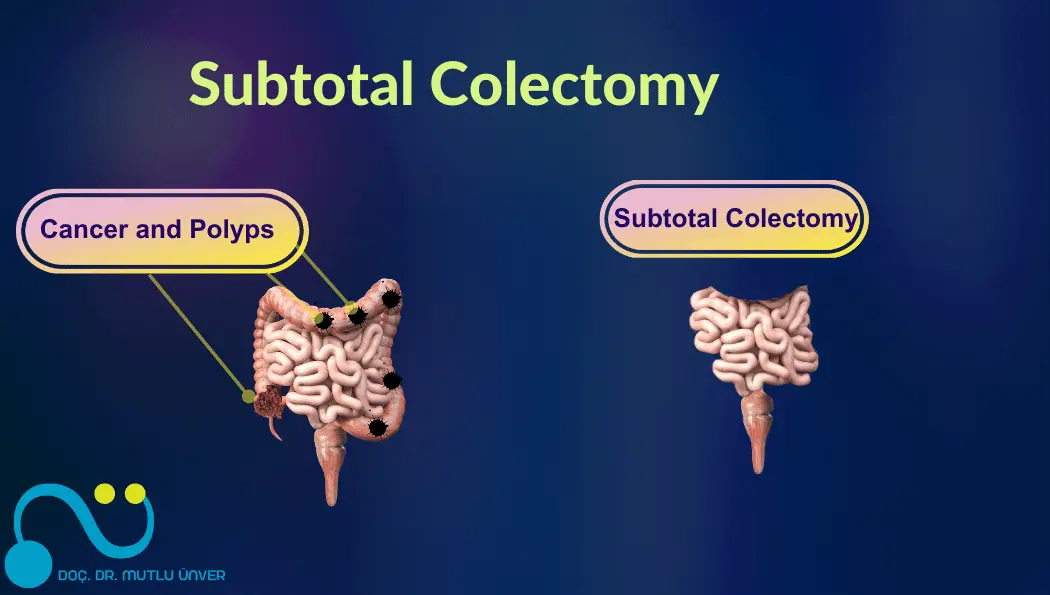 Colon (Bowel) Cancer Treatment Methods - Types of Surgery | Assoc.Prof ...