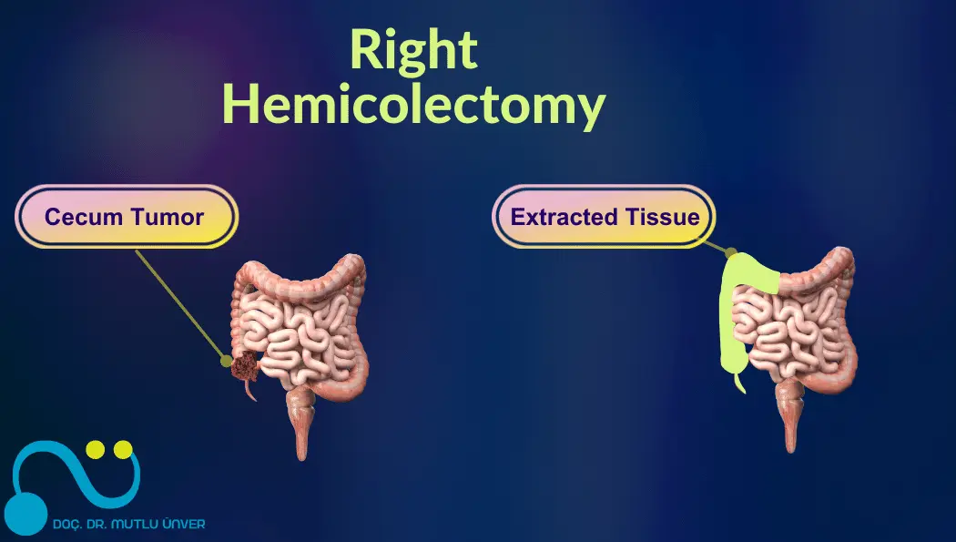 Colon (Bowel) Cancer Treatment Methods - Types of Surgery | Assoc.Prof ...
