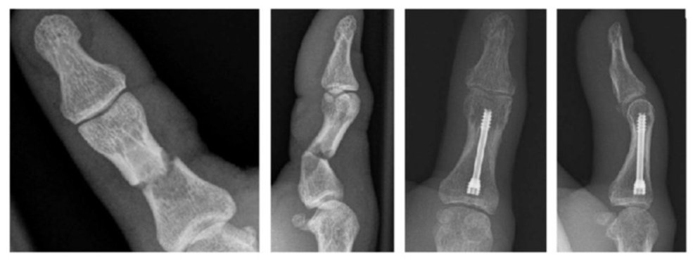 Fractura De Falange