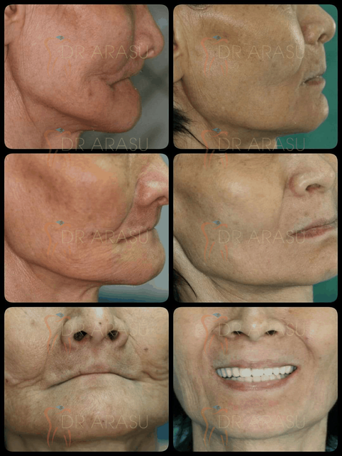 Implants | Dr Arasu Dental, Oral, Surgery & Implant Specialist | Bangsar