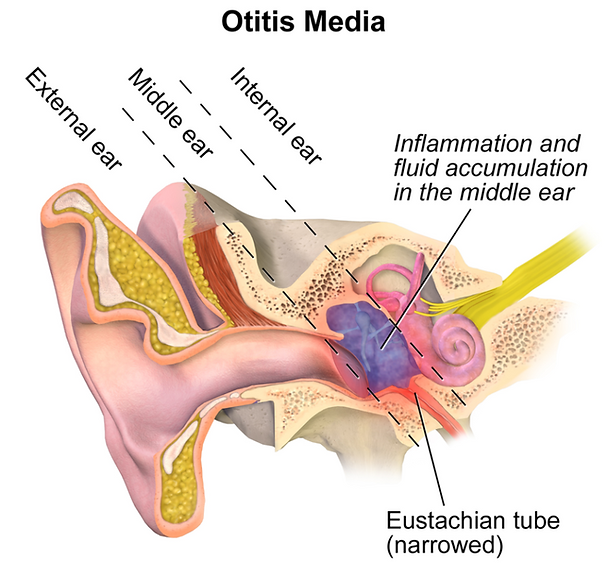 how to draw out ear infection