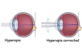 hyperopia examples