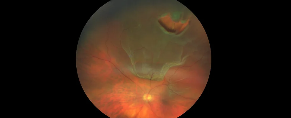 Retinal Tear | Clearview Eye Centre | Calgary