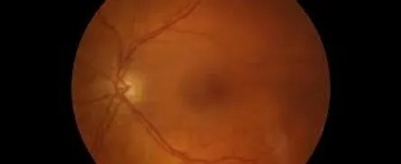 Posterior Vitreous Detachment | PVD | Clearview Eye Centre | Calgary