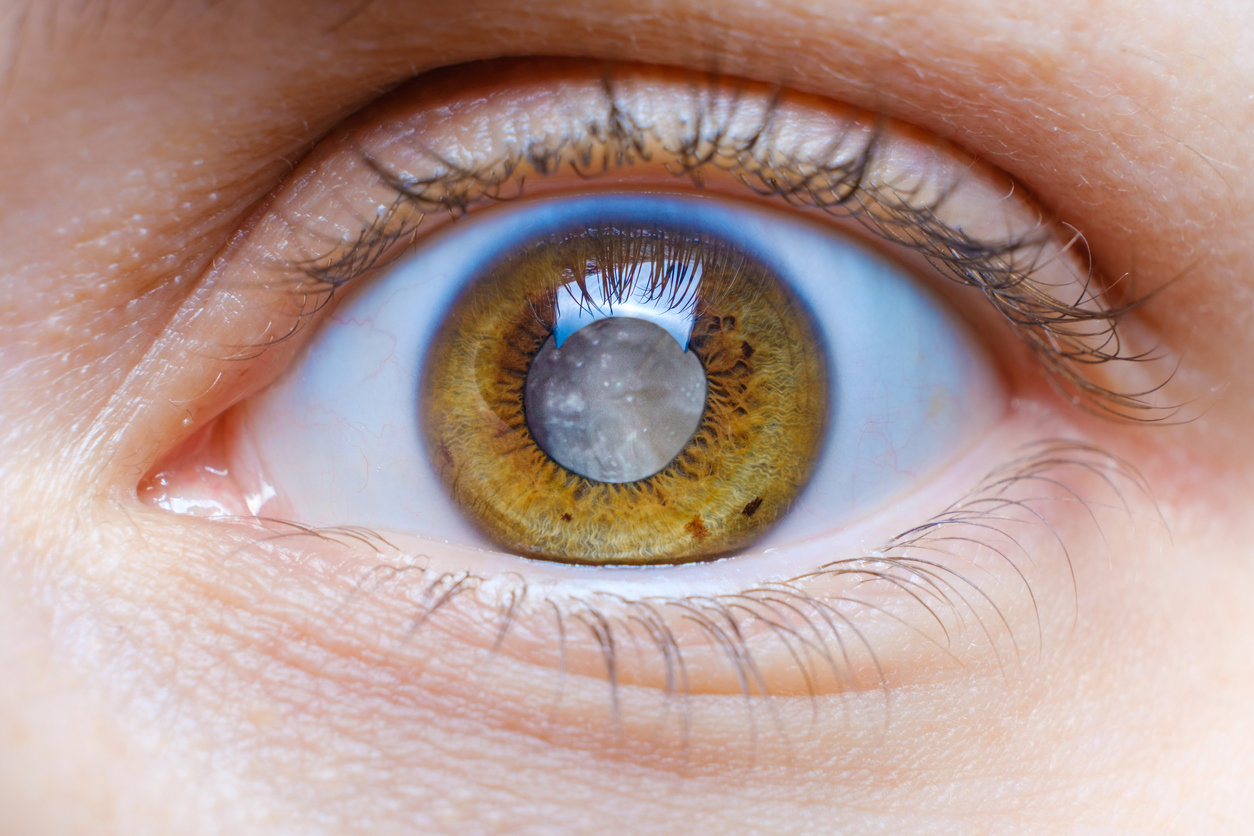 Cataract | Clearview Eye Centre | Calgary