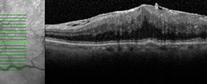 Epiretinal Membrane | Clearview Eye Centre | Calgary