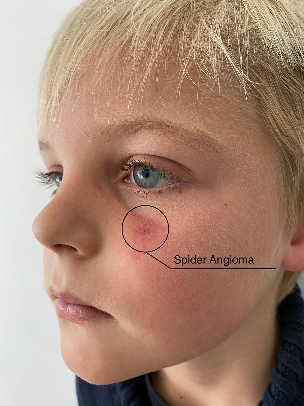 What is a Spider Angioma & What is the treatment? BBL Hero Laser ...