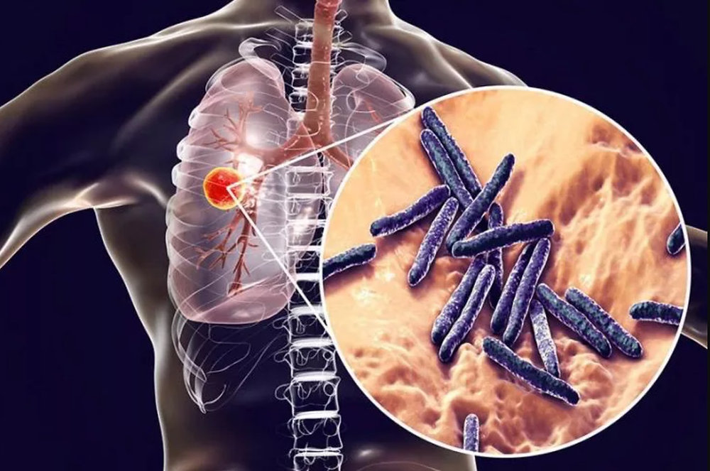 Tuberculosis: Causes and How It Spreads