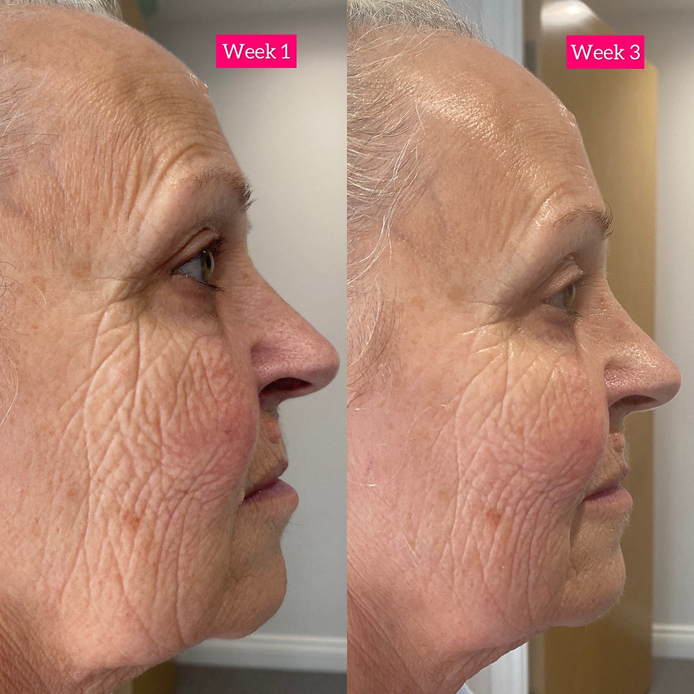 Real Results - My 12 week Skin Transformation - Part 1