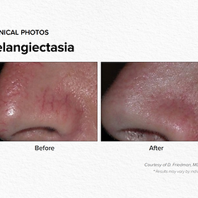 Vascular Lesions | Aba Cosmetic Pty Ltd