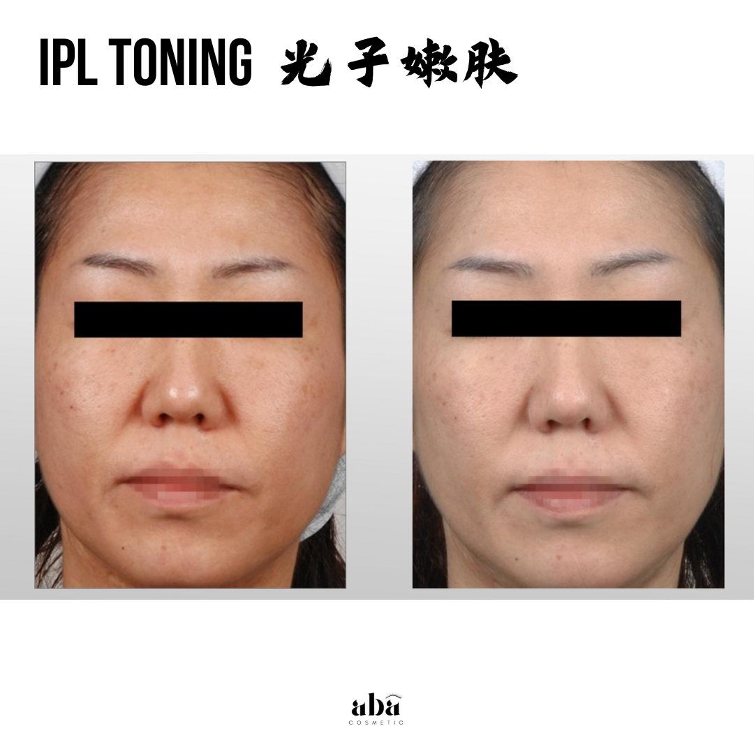 IPL | Aba Cosmetic Pty Ltd