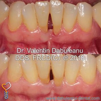 Before & After Gallery | Dabuleanu Dental