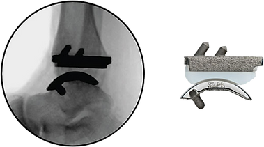 Stryker Foot & Ankle | RIOS