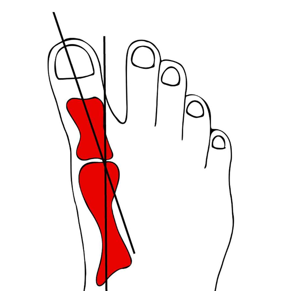 Hallux varus - causes & symptoms