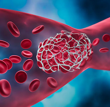 Blood Clots | Cancer Care Nevada