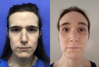 FFS - Cheek Augmentation | Dr. Toby Mayer