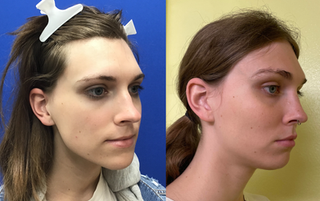 FFS - Cheek Augmentation | Dr. Toby Mayer