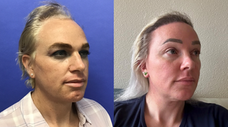 FFS - Cheek Augmentation | Dr. Toby Mayer