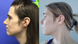 FFS - Cheek Augmentation | Dr. Toby Mayer