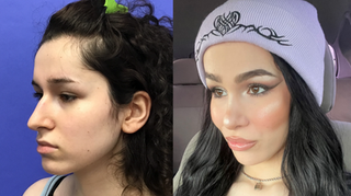 FFS - Cheek Augmentation | Dr. Toby Mayer