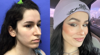 FFS - Cheek Augmentation | Dr. Toby Mayer