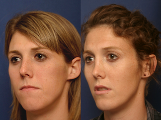 FFS - Cheek Augmentation | Dr. Toby Mayer