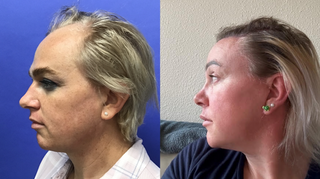 FFS - Cheek Augmentation | Dr. Toby Mayer