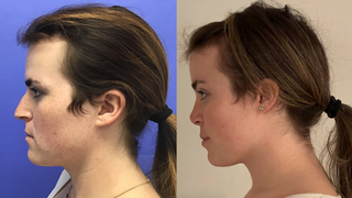 FFS - Cheek Augmentation | Dr. Toby Mayer