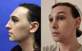 FFS - Cheek Augmentation | Dr. Toby Mayer