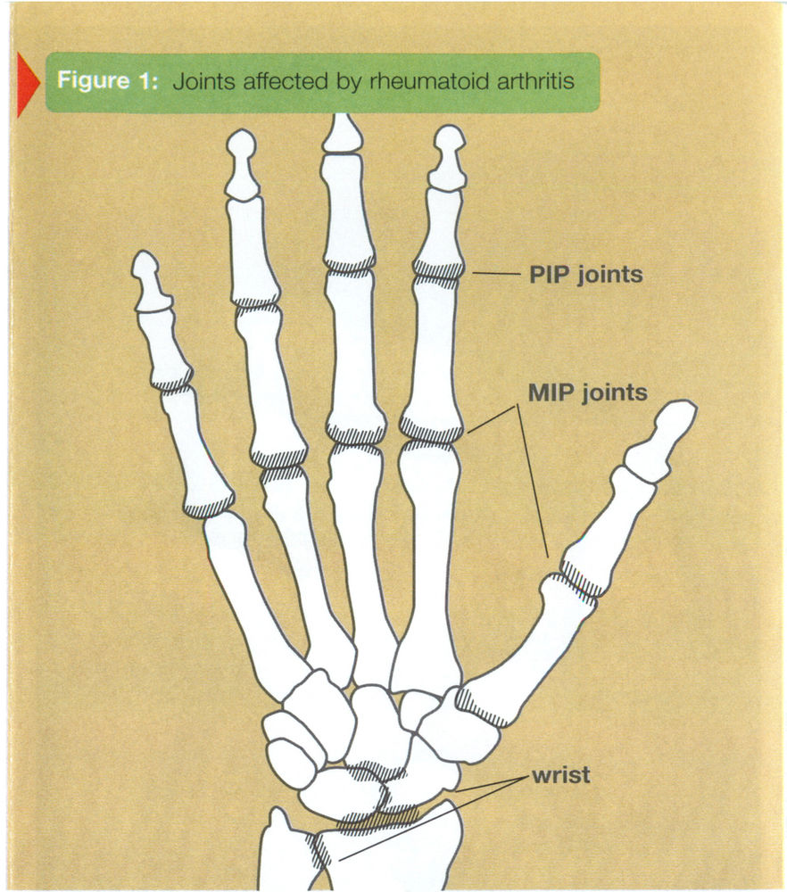 Rheumatoid Arthritis of the Hand
