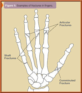 Hand Fractures