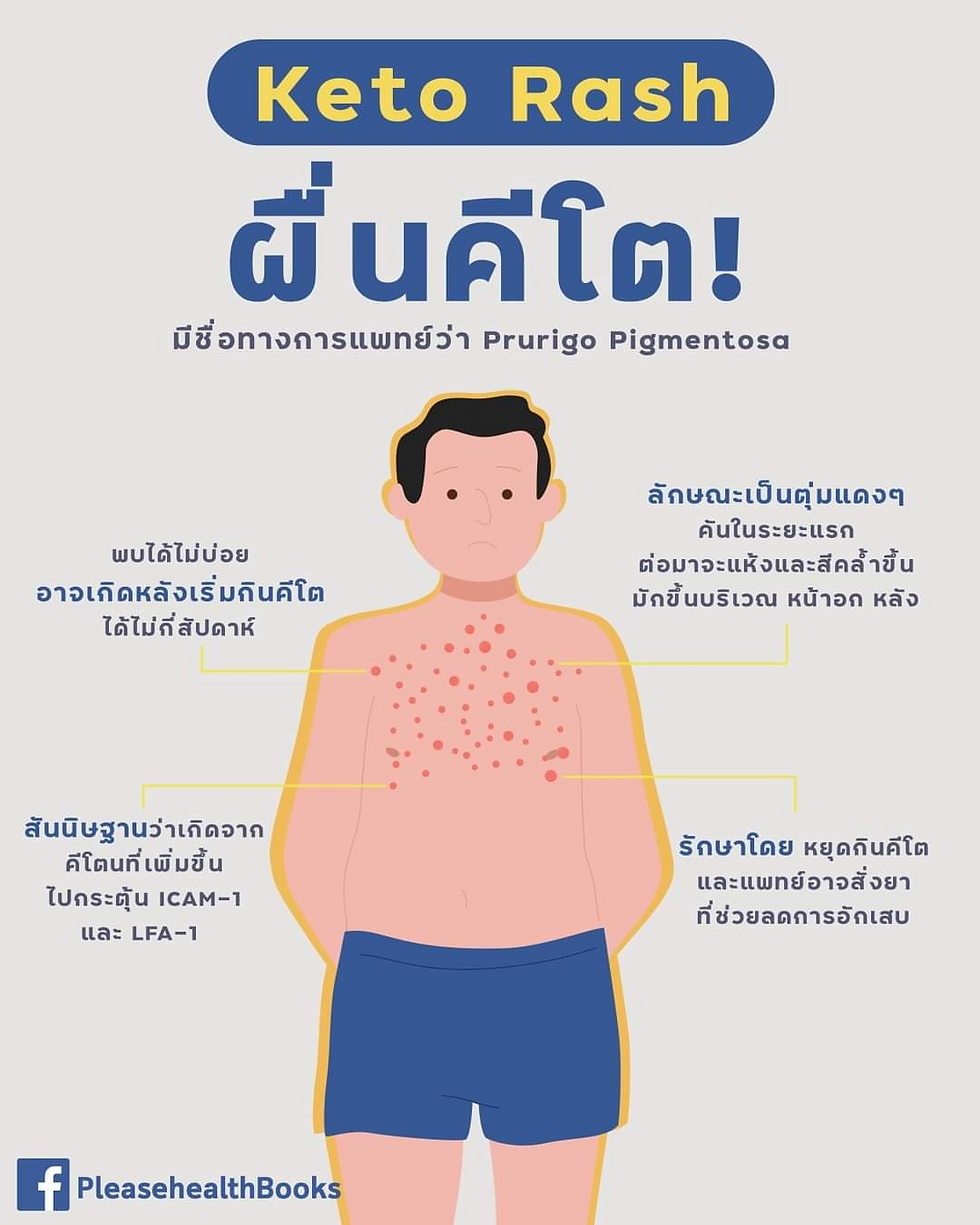 KETO RASH ผื่นคีโต ลักษณะอย่างไร เกิดจากอะไร รักษาอย่างไร