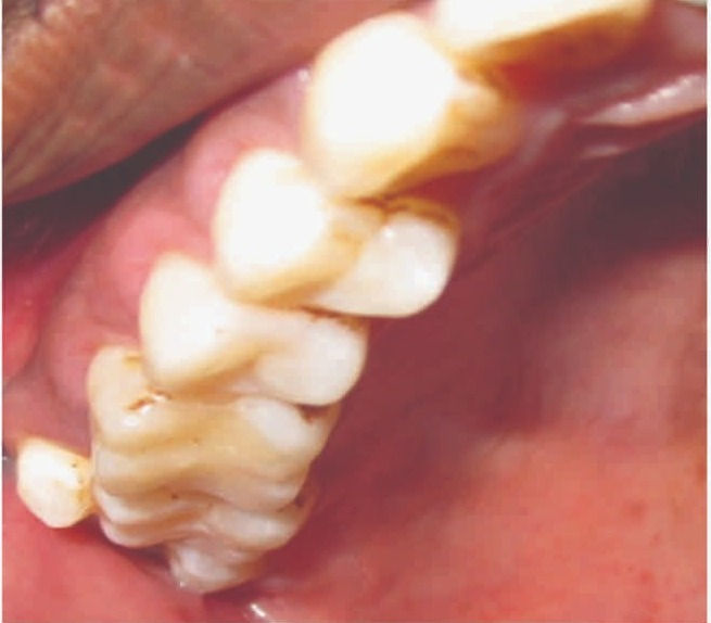 DEALING WITH SUPERNUMERARY TEETH: WHAT TO DO WHEN YOU HAVE AN EXTRA TOOTH