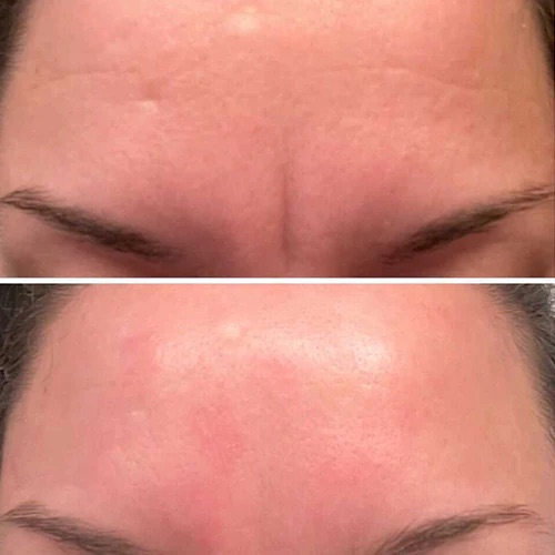 Forehead & Between Eyes Wrinkle Patches | Frownies Canada
