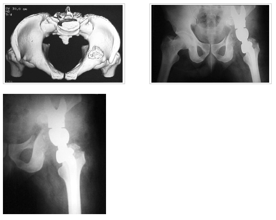 Clinical Illustrations | Custommegaprosthesis