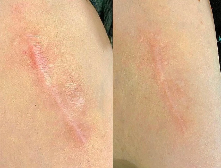 Scar Revision Micro-Needling | Au Naturel Studio