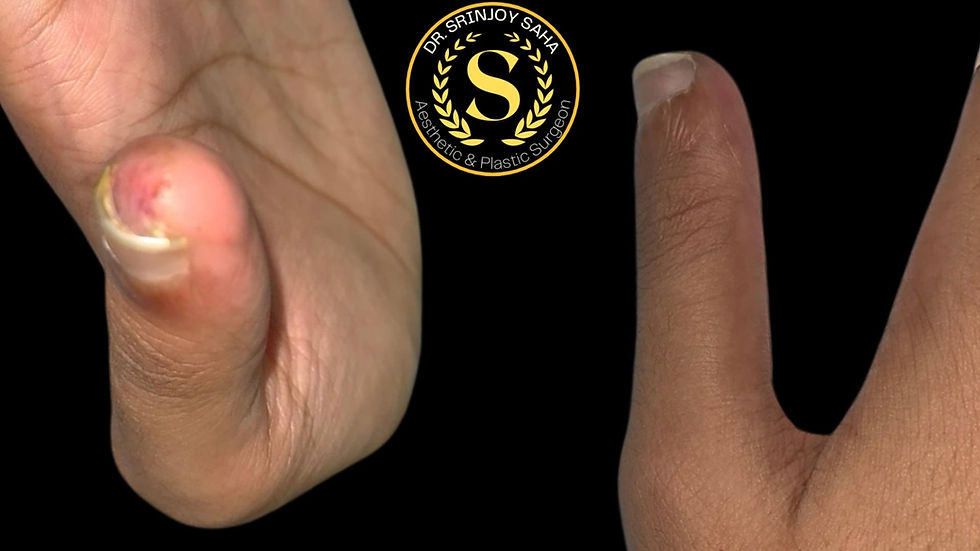 Thumb Regeneration: An Incredible Case Study Restoring Hope with ...