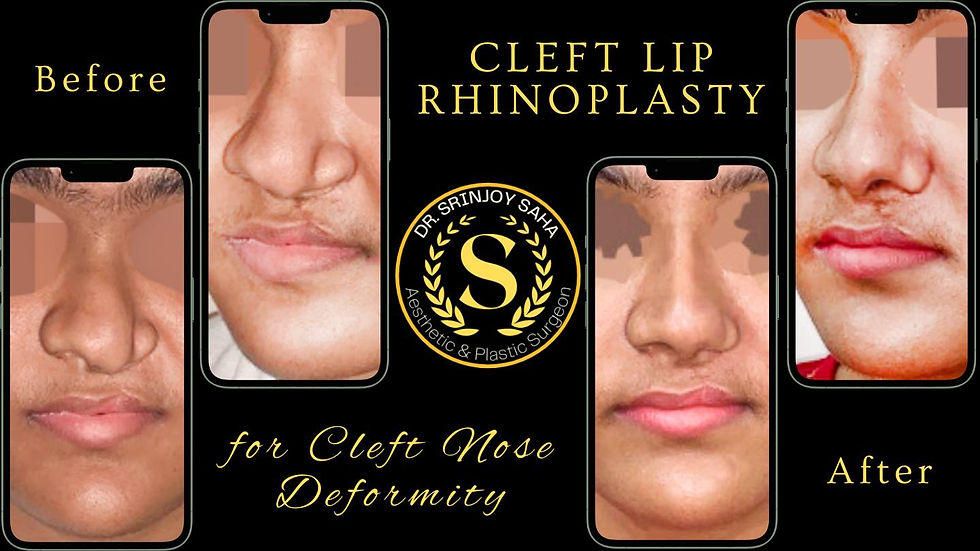 Transforming Cleft Nose Deformity: A Young Girl's Rhinoplasty Journey ...