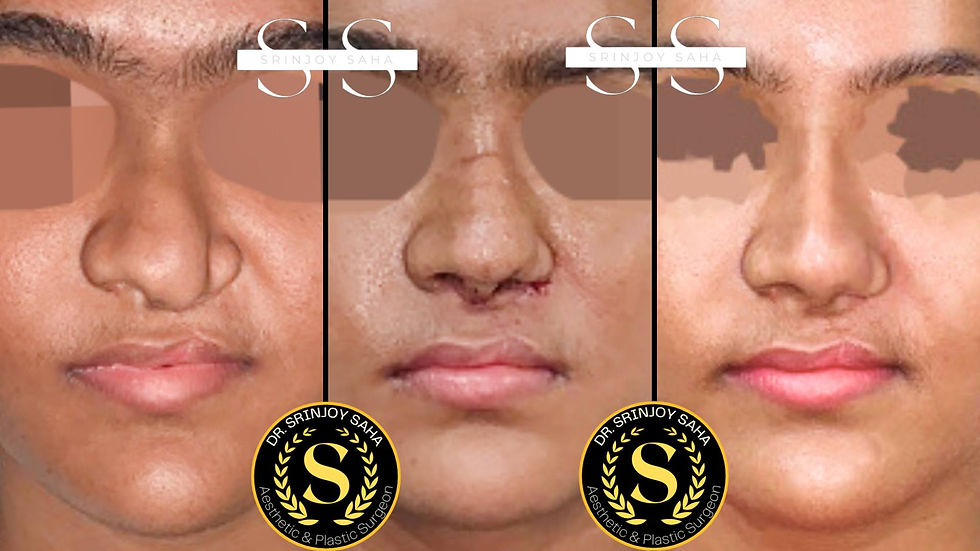 Transforming Cleft Nose Deformity: A Young Girl's Rhinoplasty Journey ...