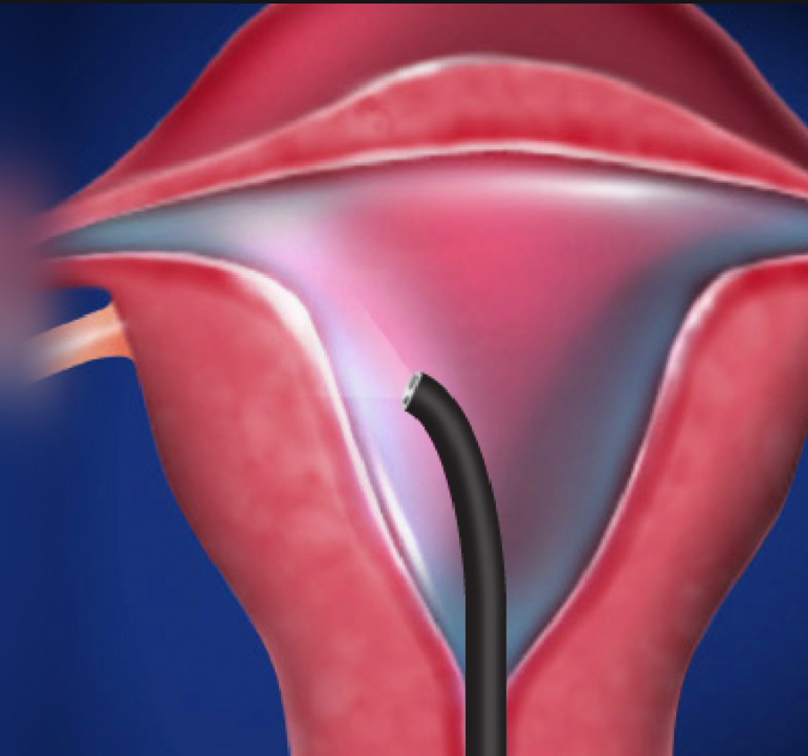 Hysteroscopy Hysteroscopy